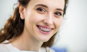 Types of Braces Materials, and How to Choose