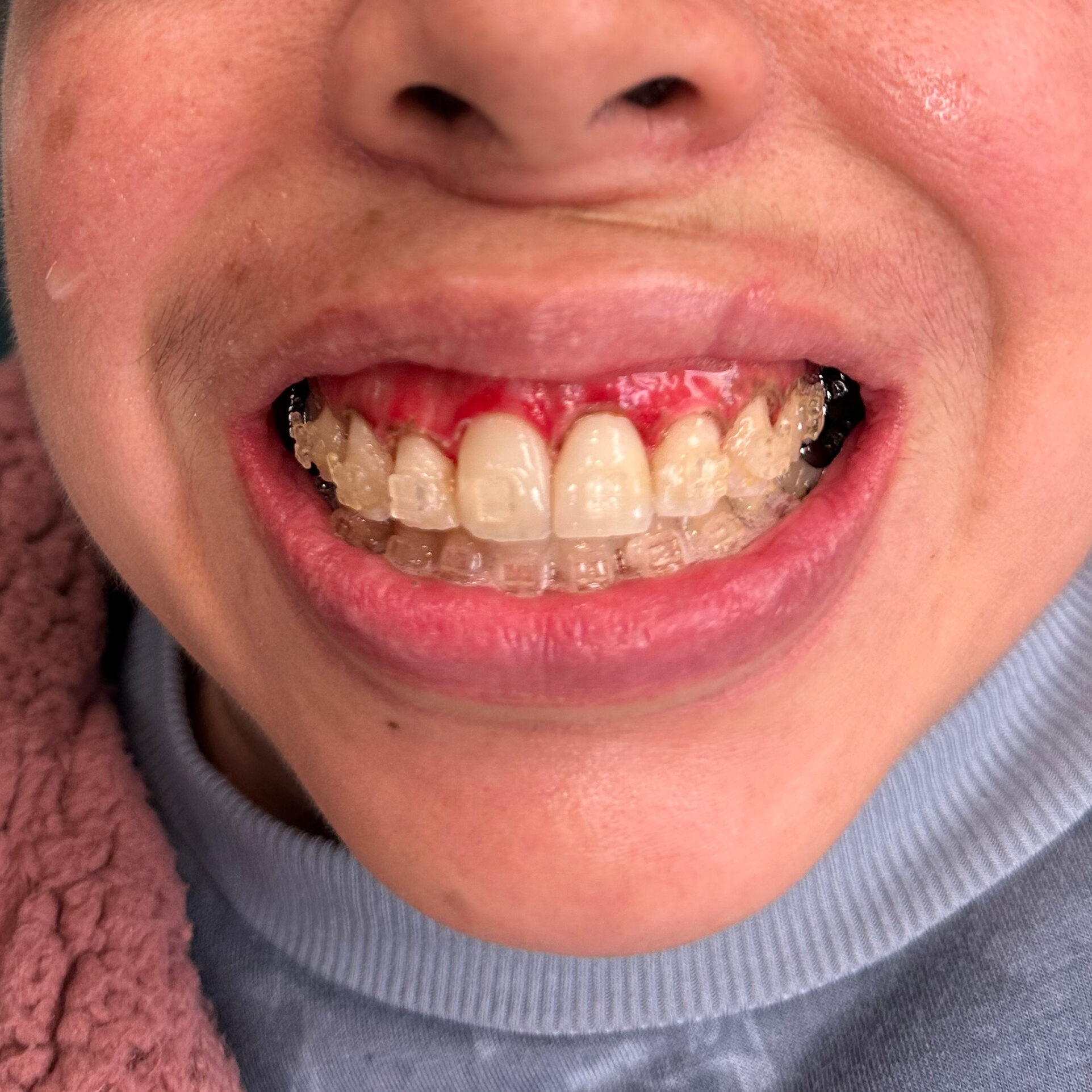 Treatment Options | Watson Orthodontics